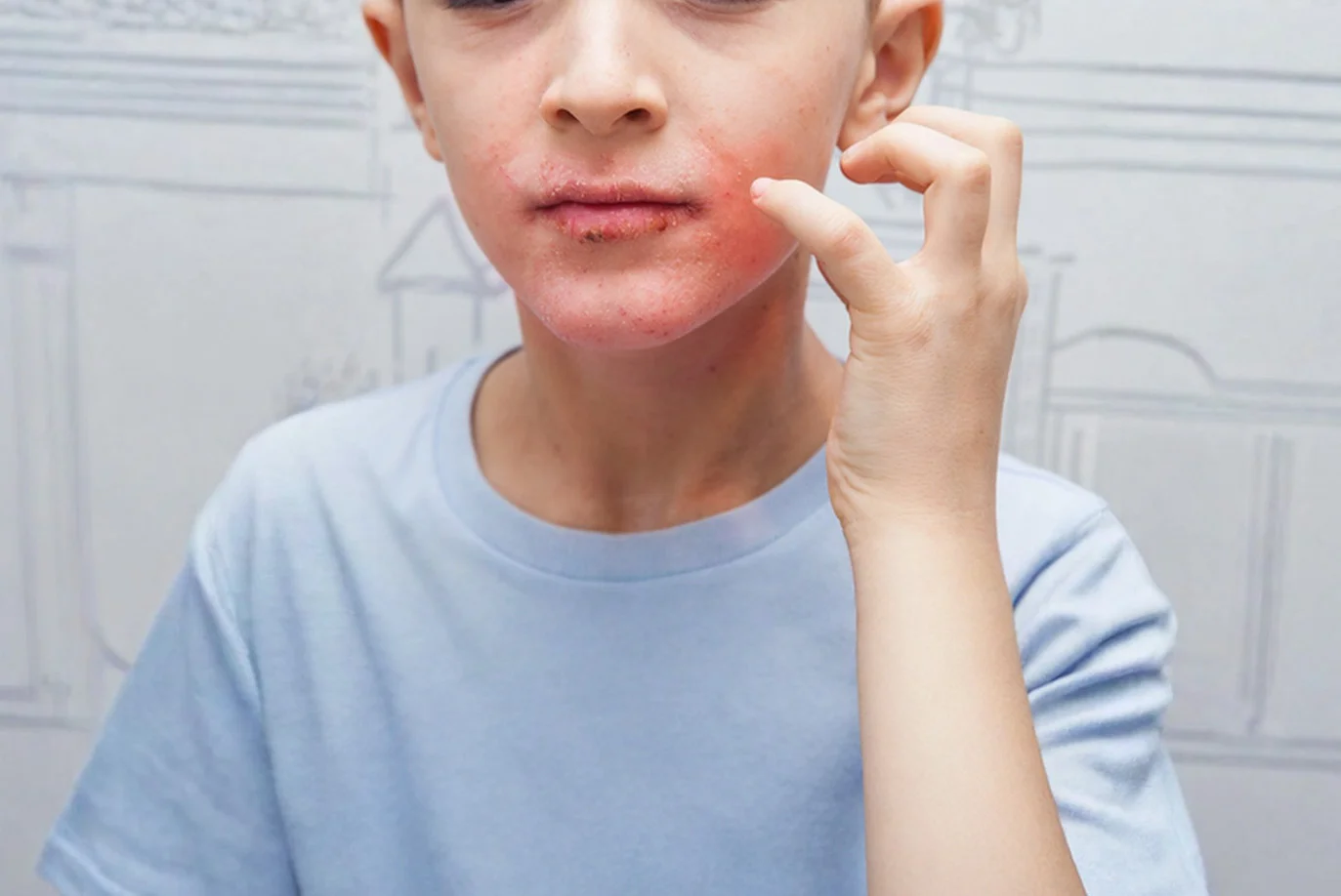Impetigo - Park View Pharmacy